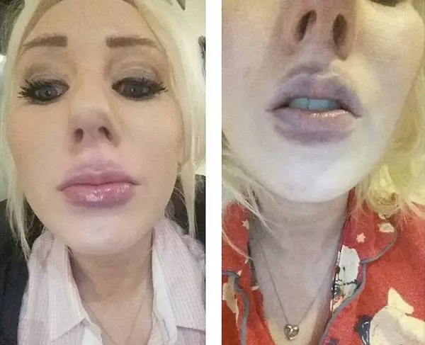 Vrouw gebruikt haarlakfles om Kylie Jenner-lippen te krijgen, faalt jammerlijk 9820_1